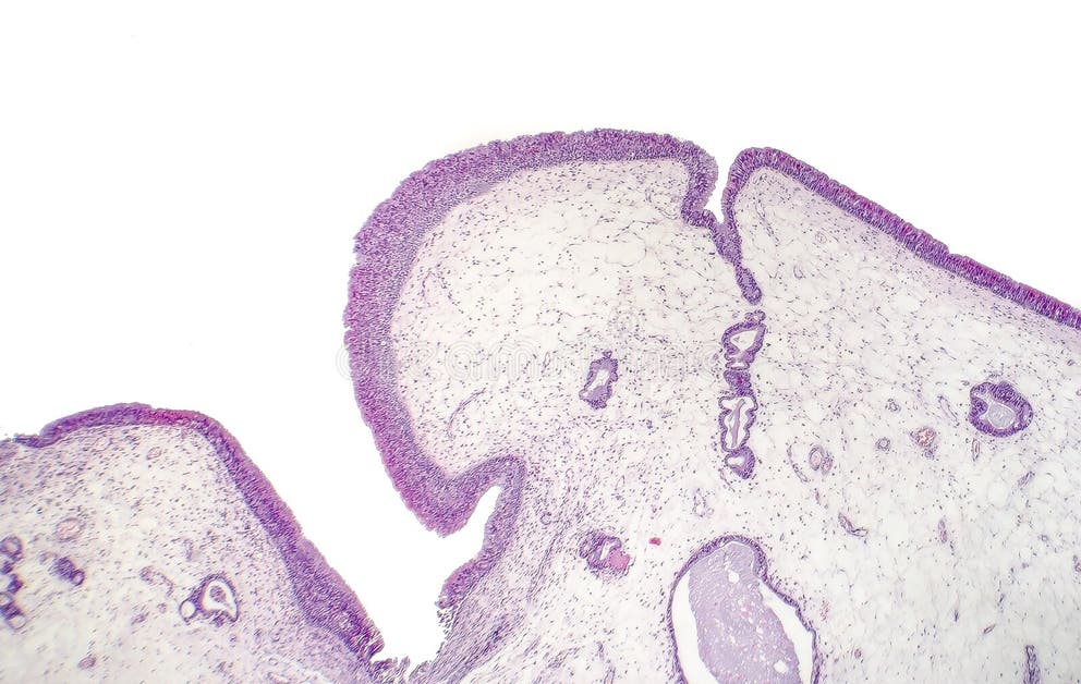 Inflammatory Polyp, Light Micrograph Stock Photo - Image of ...