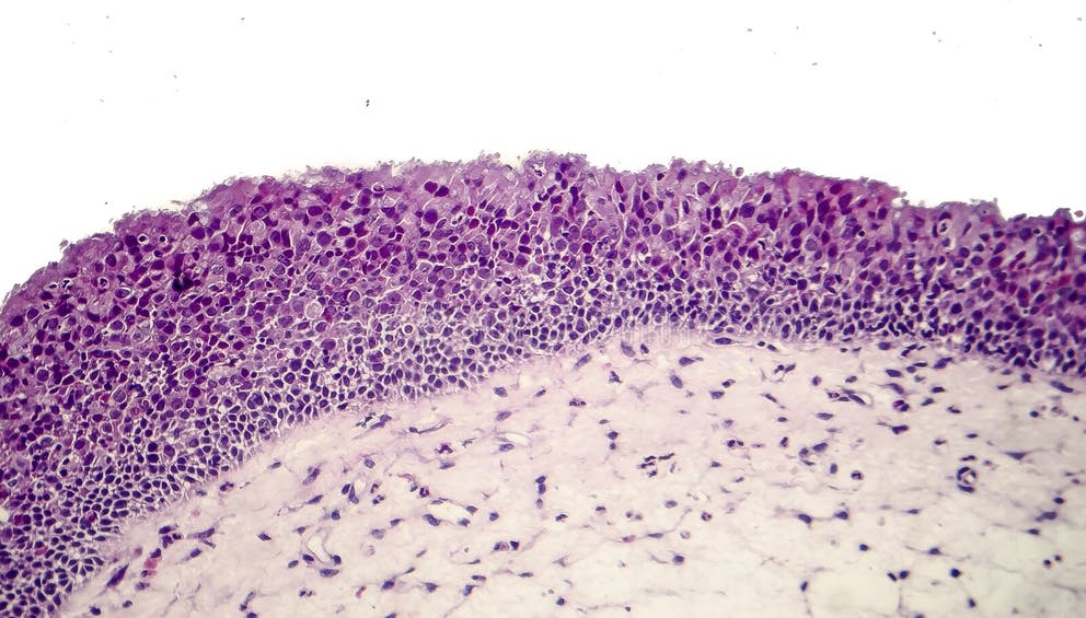 Inflammatory Polyp, Light Micrograph Stock Image - Image of cell ...