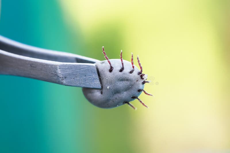 Inflated Blood Tick Pulled Out Metal Tongs Stock Photos - Free ...