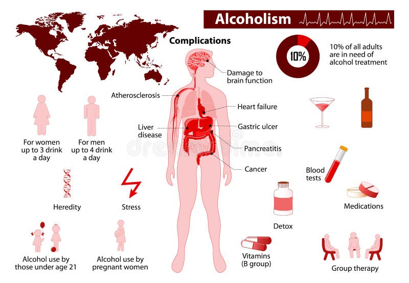Infographic Over Alcoholisme Vector Illustratie - Illustration of ...