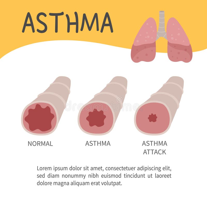 Infographic astma vector illustratie. Illustration of aanval - 126521110