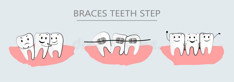 Infographic braces stock vector. Illustration of casual - 123969883