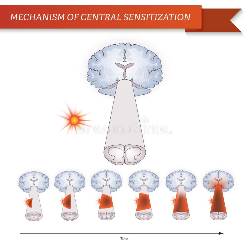 Infographic Mechanism of Central Sensitization. Stock Vector ...