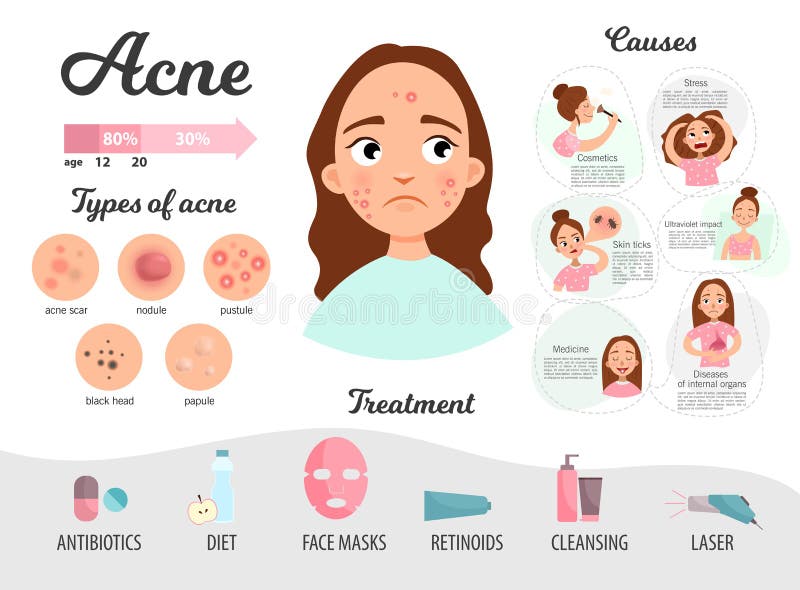 Infographics da acne ilustração do vetor. Ilustração de limpo - 122414040
