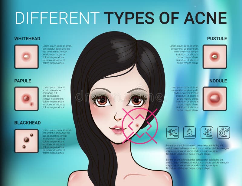 Infographics of Different Type of Skin Acne Stock Vector - Illustration ...