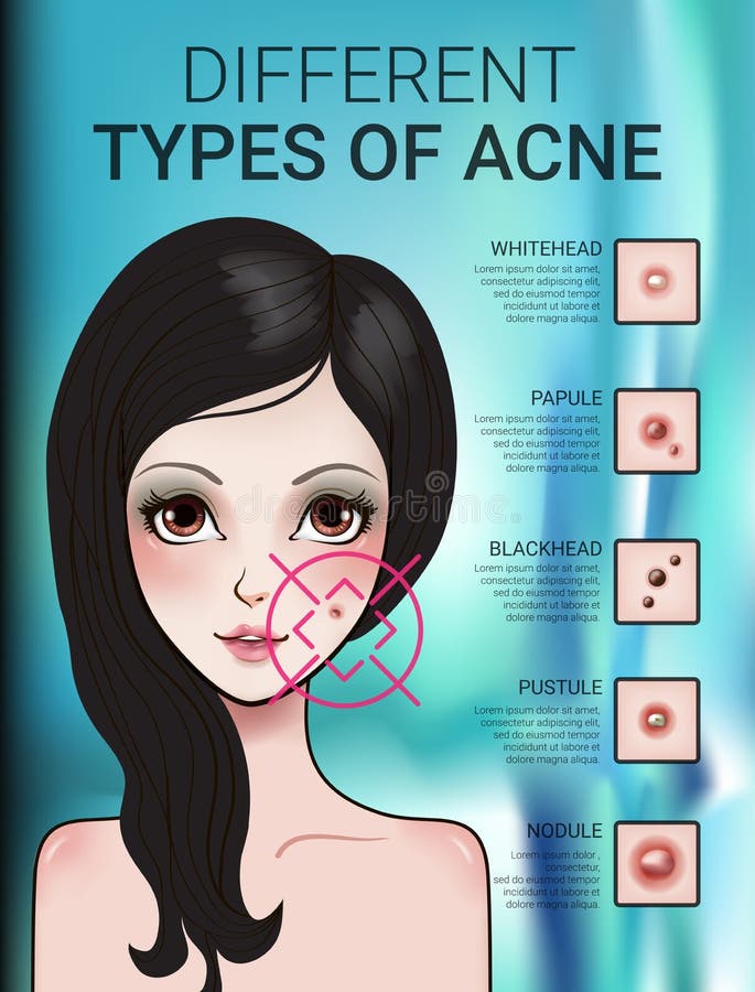 Infographics of Different Type of Skin Acne Stock Vector - Illustration ...