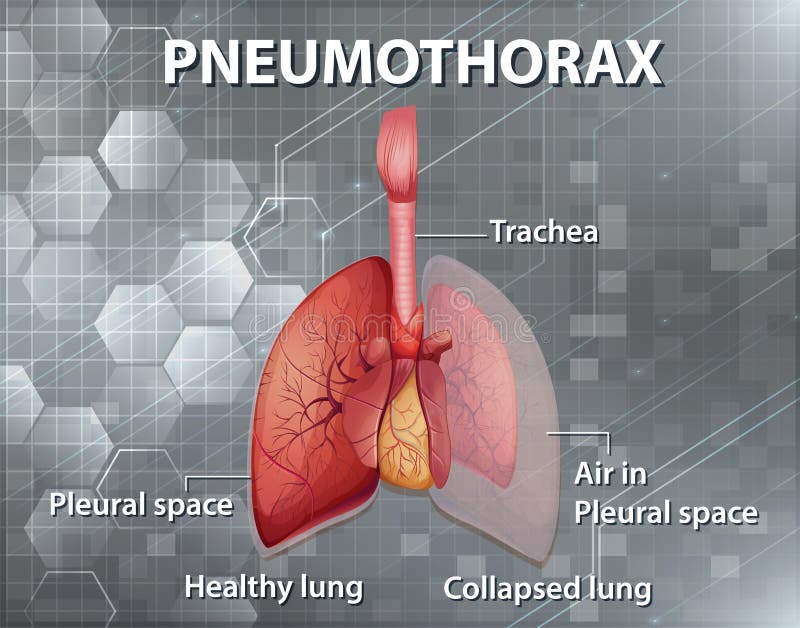 Pneumothorax Normale Lunge Versus Kollabierte Symptome Von Pneumothorax ... Pneumothorax Normale Lunge Versus Kollabierte Symptome Von Pneumothorax ...