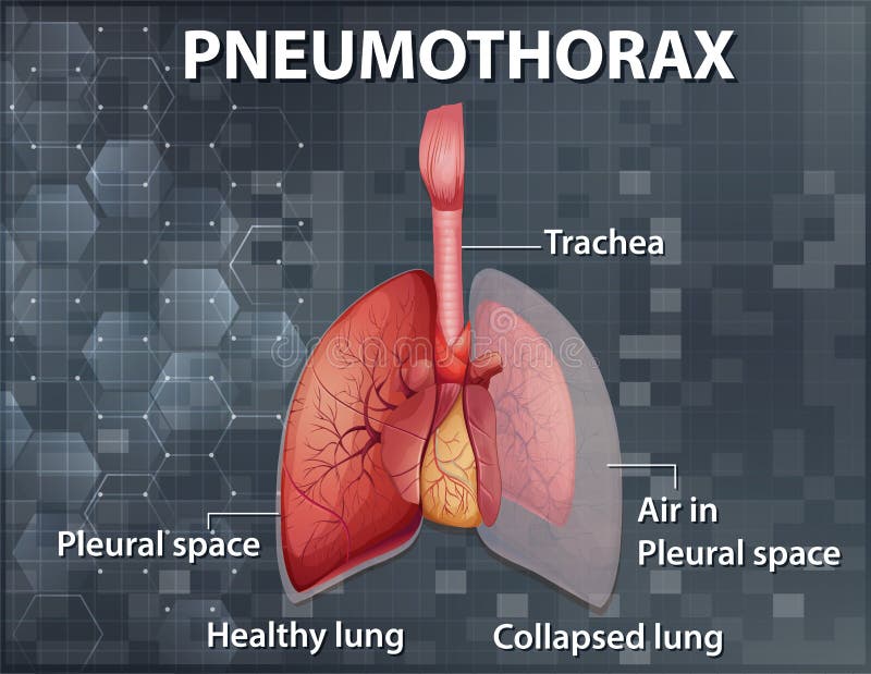 3d Darstellung Der Normalen Lunge Des Pneumothorax Im Vergleich Zum ... 3d Darstellung Der Normalen Lunge Des Pneumothorax Im Vergleich Zum ...
