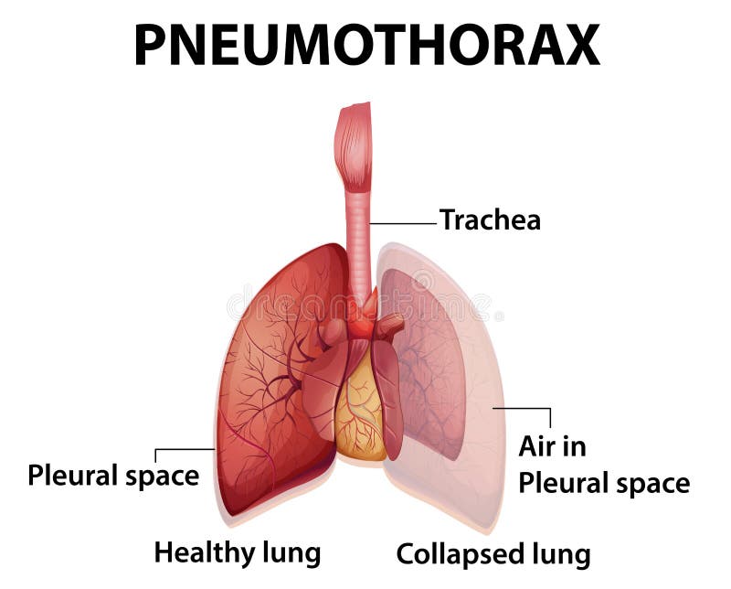 Pneumothorax Normale Lunge Versus Kollabierte Symptome Von Pneumothorax ... Pneumothorax Normale Lunge Versus Kollabierte Symptome Von Pneumothorax ...