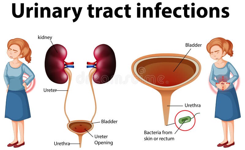 Informative Illustration of Urinary Tract Infections Stock Vector ... Informative Illustration of Urinary Tract Infections Stock Vector ...