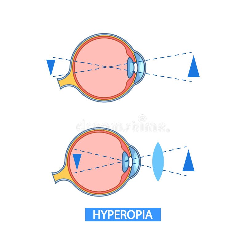 Depicting Hyperopia Stock Illustrations – 3 Depicting Hyperopia Stock ...