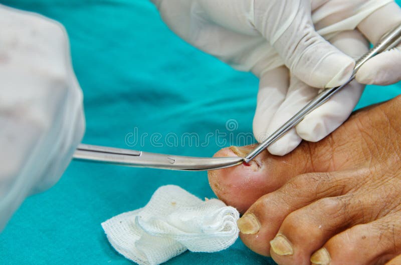 Blood wound finger nail stock photo. Image of canker - 17500550