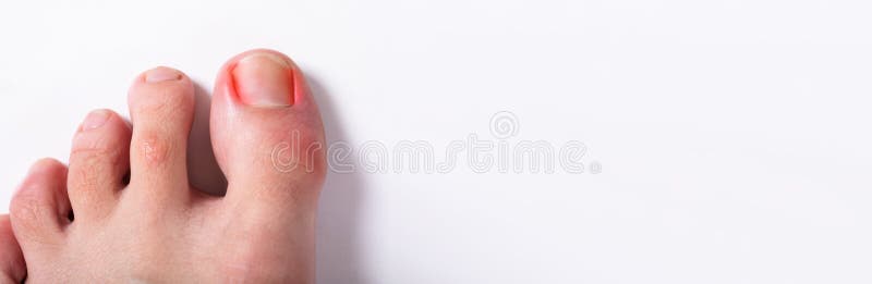 Ingrown Toenail stock image. Image of toenail, heel - 255777153