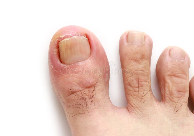 Ingrown toenail stock image. Image of barefoot, wound - 56054895
