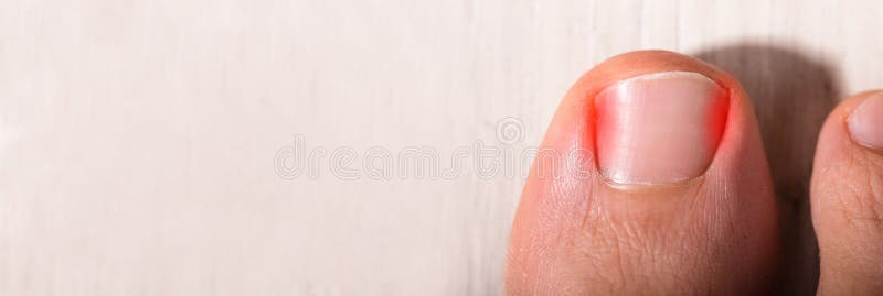Ingrown Toenail Problem stock photo. Image of problem - 255777858
