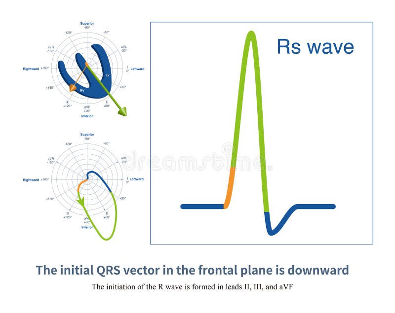 The Initial QRS Vector in the Frontal Plane is Downward Stock ...