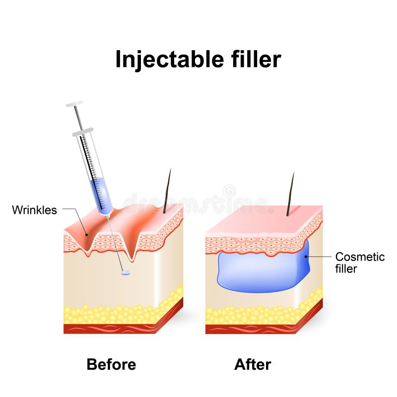 Injectable Cosmetic Filler. How it Works Stock Vector - Illustration of ...