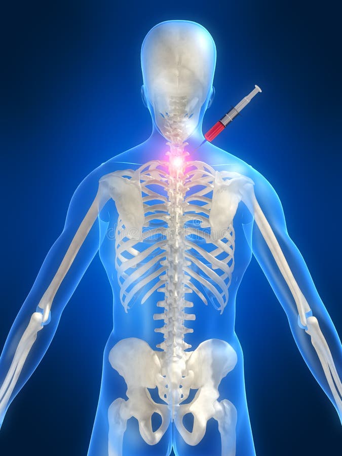 Injection stock illustration. Illustration of inflammation - 2609831
