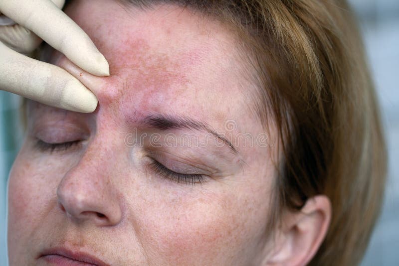 Pigmentation Sur Le Visage Tache Brune Sur La Joue Tache De Colorant ...