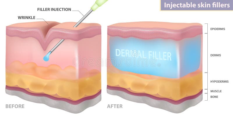 Injection Filler Injection Under the Skin, Vector Illustration Stock ...