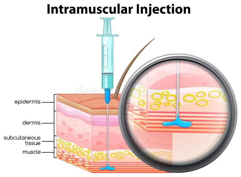 Techniques Sous-cutanées Et D'injection Intramusculaire Illustration de ...