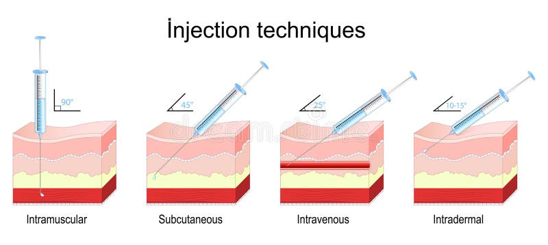 Injection Methods. Intramuscular, Subcutaneous, Intravenous, and ...