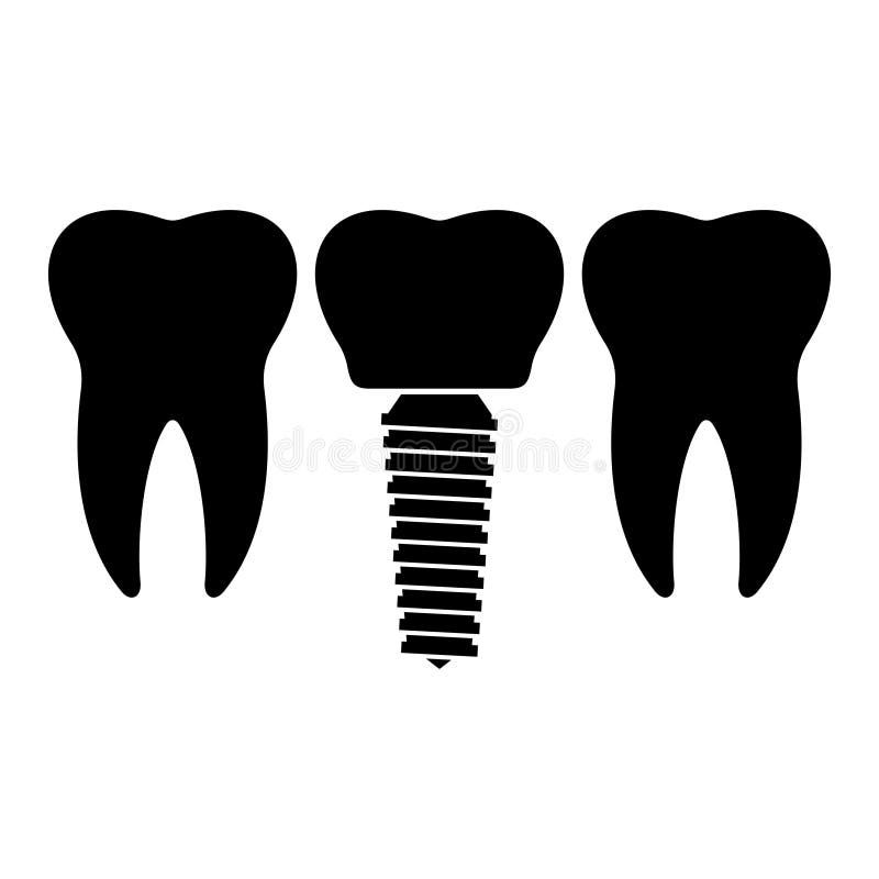 Injerto dental ilustración del vector. Ilustración de médico - 116173732