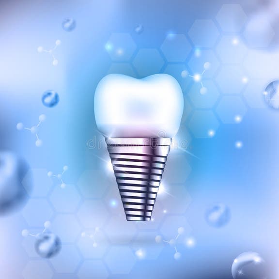 Injerto dental ilustración del vector. Ilustración de moderno - 88586935