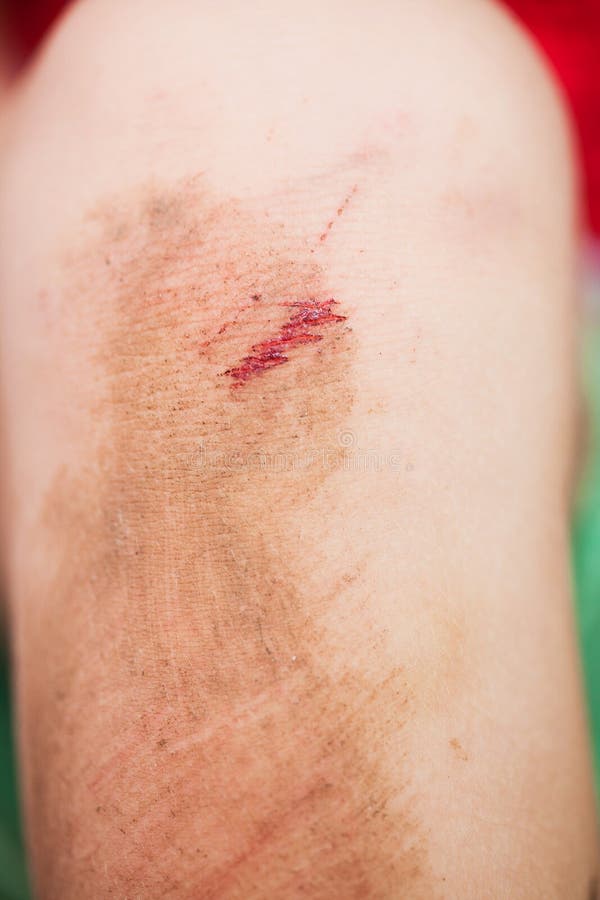 Injured child leg stock photo. Image of hurt, painful - 30229920