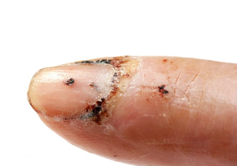 Injured Finger stock image. Image of finger, hospitalisation - 3303027