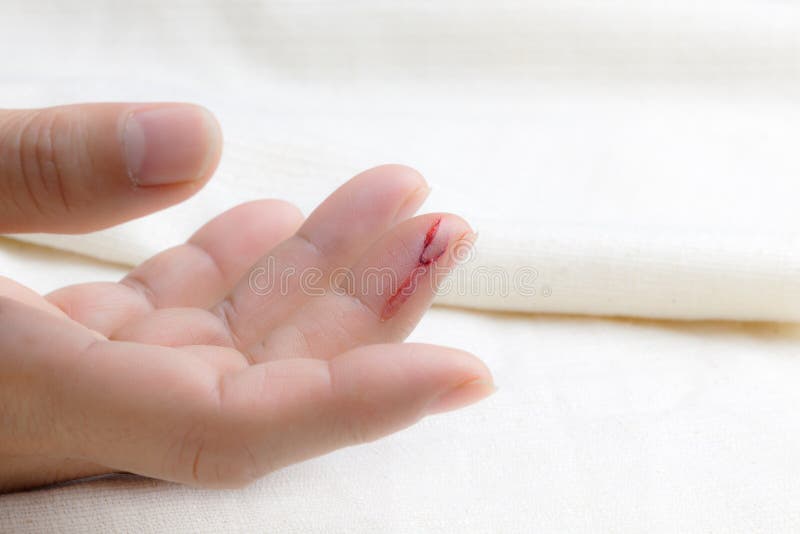 Thumb cut wound stock photo. Image of imprint, knife - 57954646