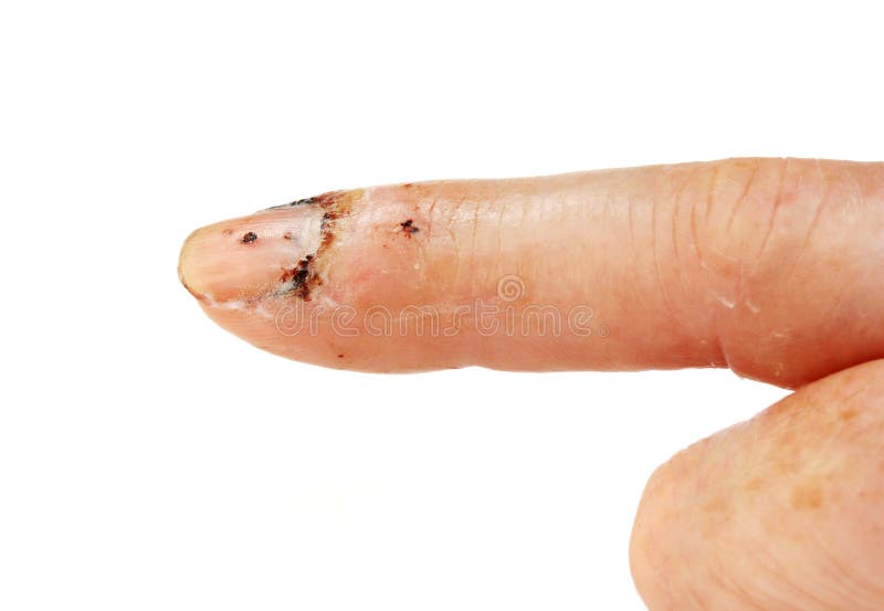 Injured Finger Close Up stock image. Image of phalanx - 3303075