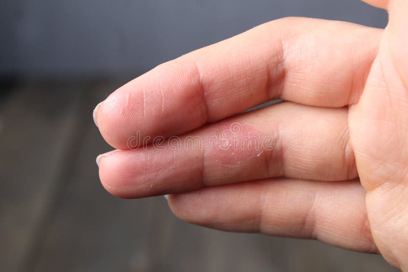 Injured Finger. a Mark of a Healed Wound on a Finger Stock Image ...