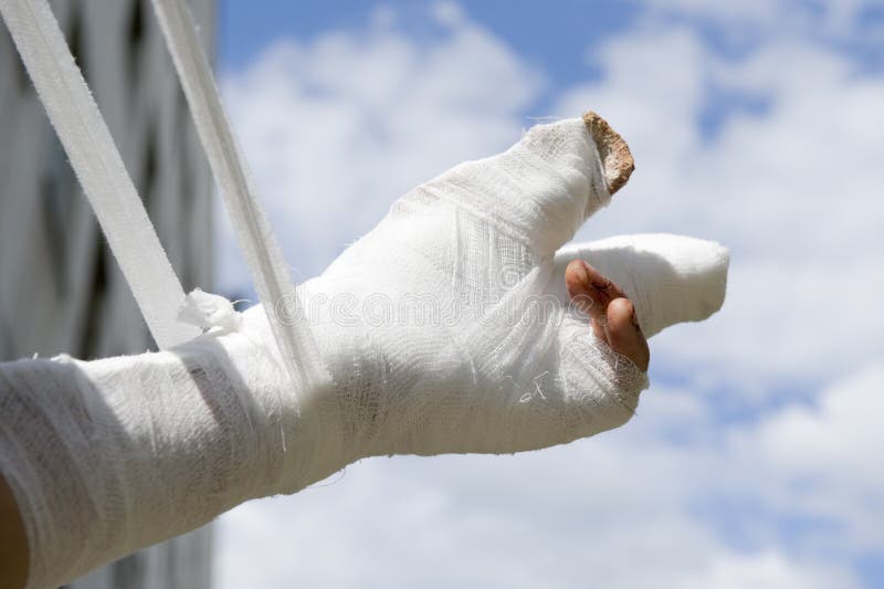 Injured hand stock image. Image of accident, painful - 18197795