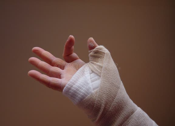 Injured hand with cast stock image. Image of thumb, scafoideum - 19077445