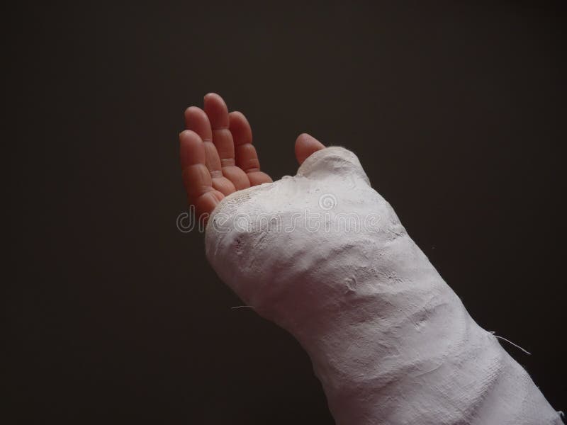 Injured hand with cast stock photo. Image of patient - 25161484
