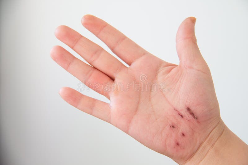 Injured hand with cast stock image. Image of thumb, scafoideum - 19077445