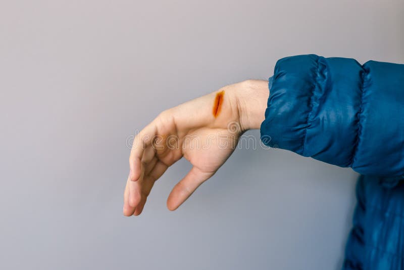 Injured Hand with Open Cut, Iodine-treated Stock Image - Image of ...