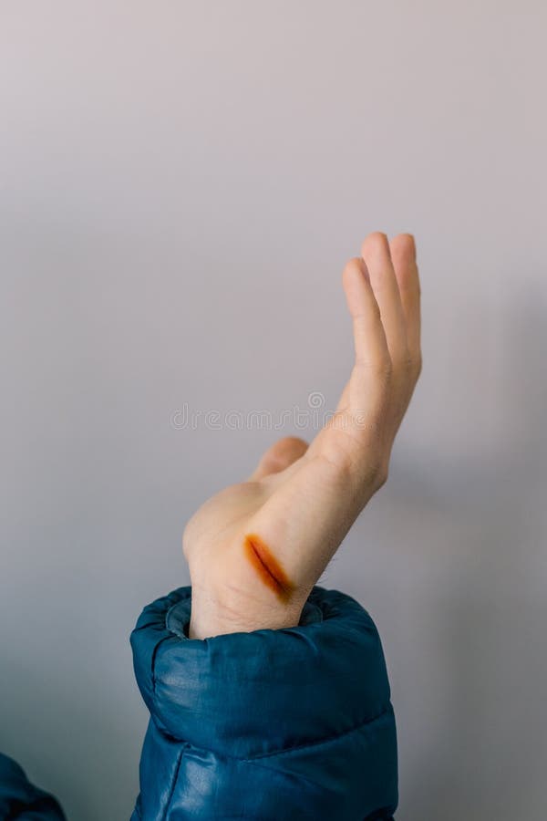 Injured Hand with Open Cut, Iodine-treated Stock Image - Image of ...