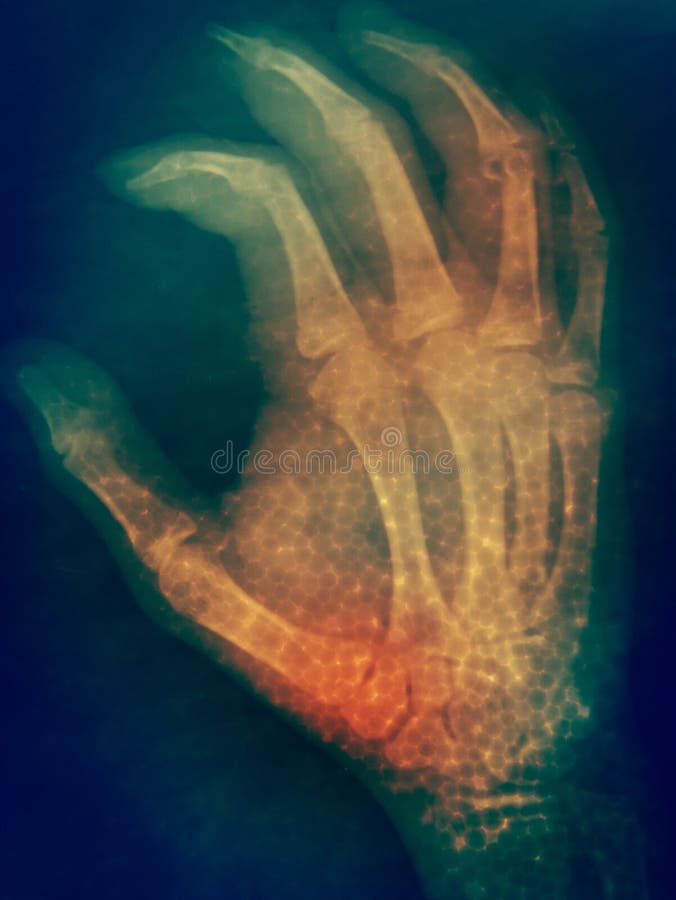 Hand X-ray on dark stock image. Image of hospital, disease - 90274823