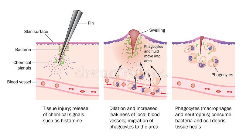 Injury and inflammation stock vector. Illustration of macrophages ...