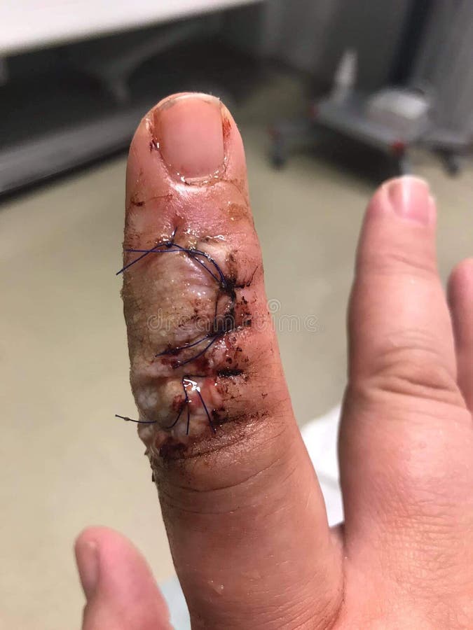 Injury at Work Finger Cut with Meat Slicer Stock Photo - Image of ...