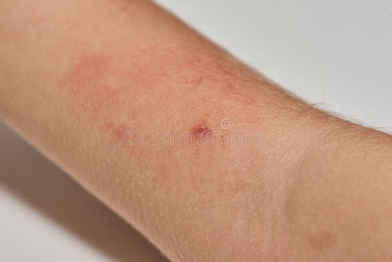 Insect Bite on Arm of Child Stock Photo - Image of dermatology, medical ...