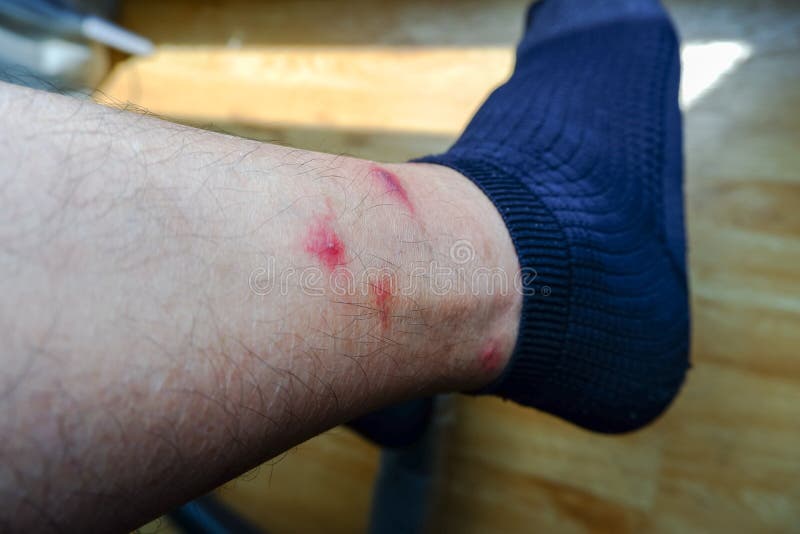 Dog Bite Leg
