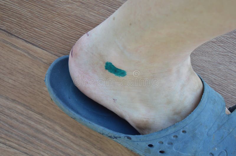 Insect Bite Wounds on Human Skin Stock Photo - Image of medical, care ...