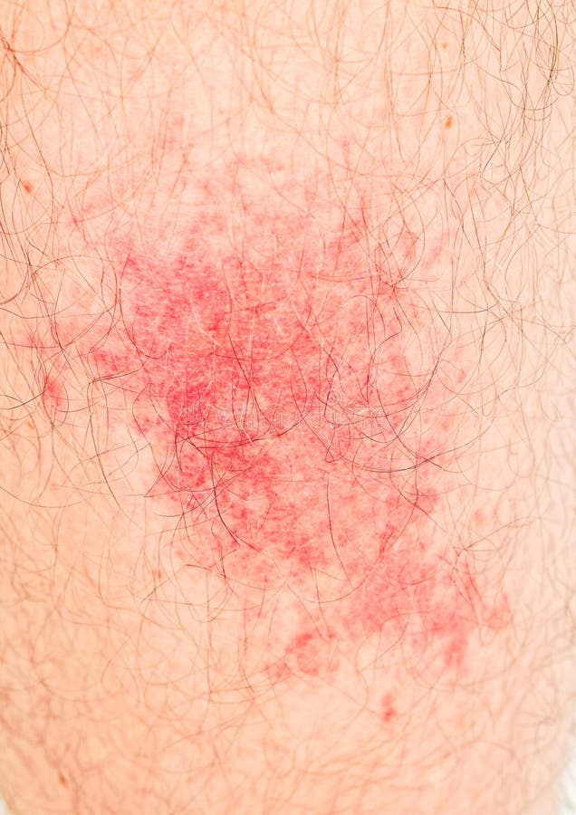 Midge Muggenbeet Reactie Op De Beet Van De Muggen Allergie Gevaar Van ...