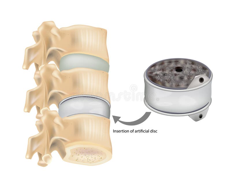 Lumbar Discectomy Stock Illustrations – 5 Lumbar Discectomy Stock ...