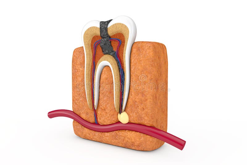 Inside of Decay Tooth. 3d Rendering Stock Illustration - Illustration ...