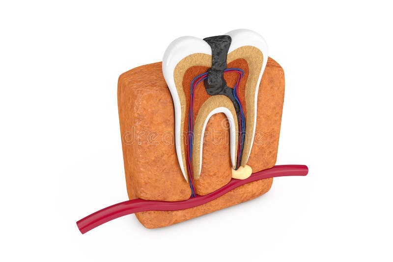Inside of Decay Tooth. 3d Rendering Stock Illustration - Illustration ...