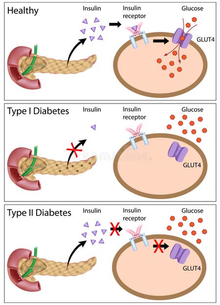 Diabetes Stock Illustrations – 35,891 Diabetes Stock Illustrations ...